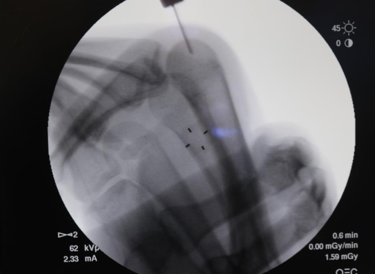 Use of NX Nail for oblique fracture fixation of 2nd metacarpal